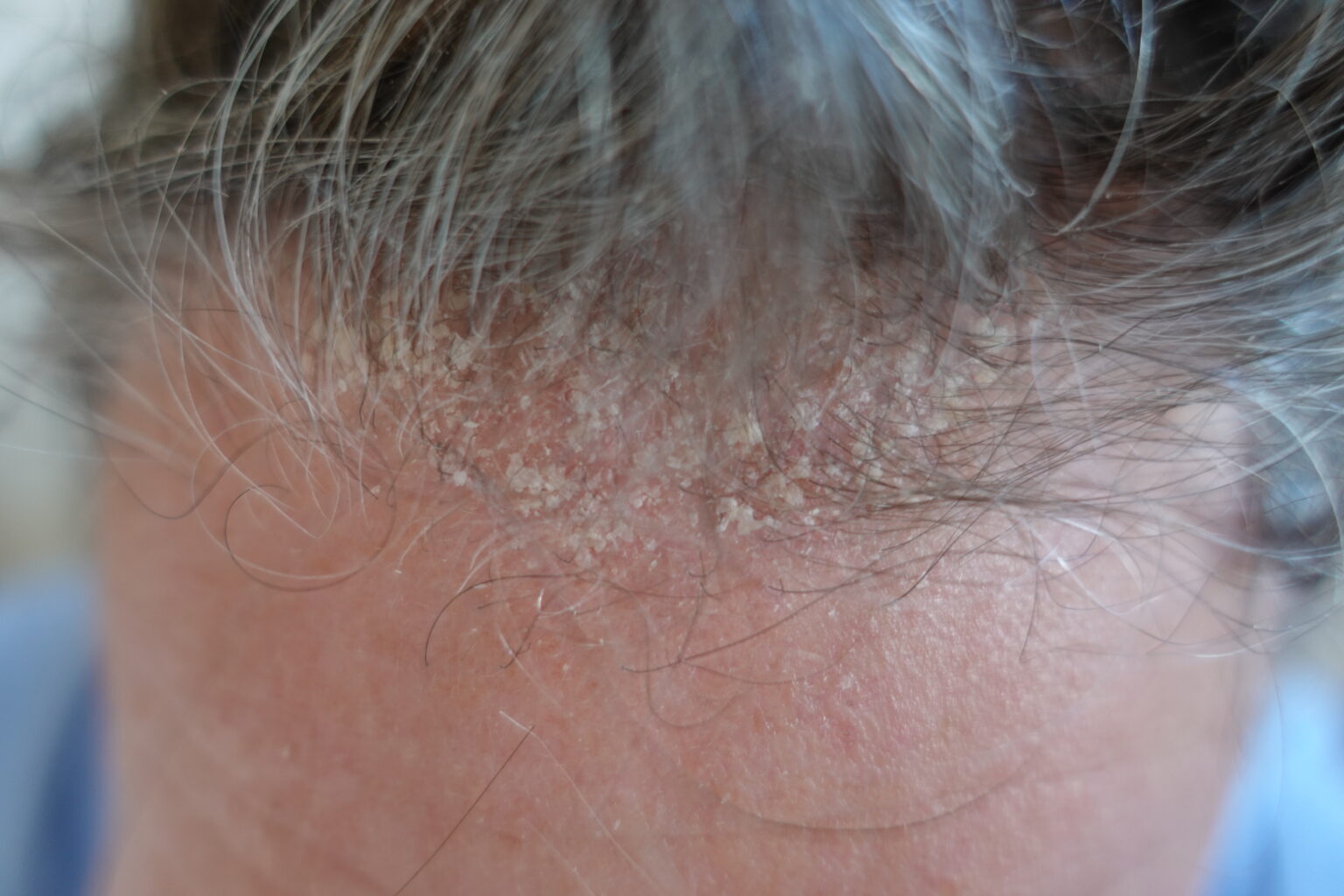 Issue 9 : Positive Results Of Scalp Seborrheic Dermatitis Treatment ...