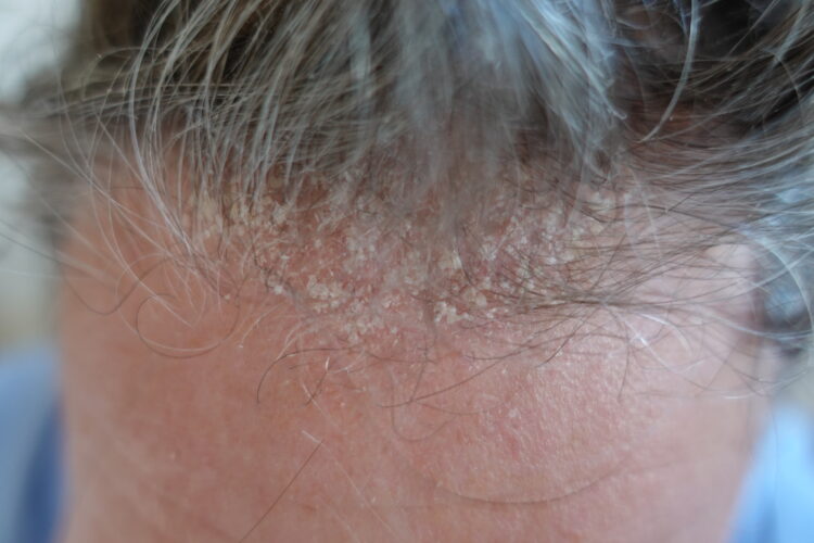 Issue 9 : Positive Results Of Scalp Seborrheic Dermatitis Treatment ...